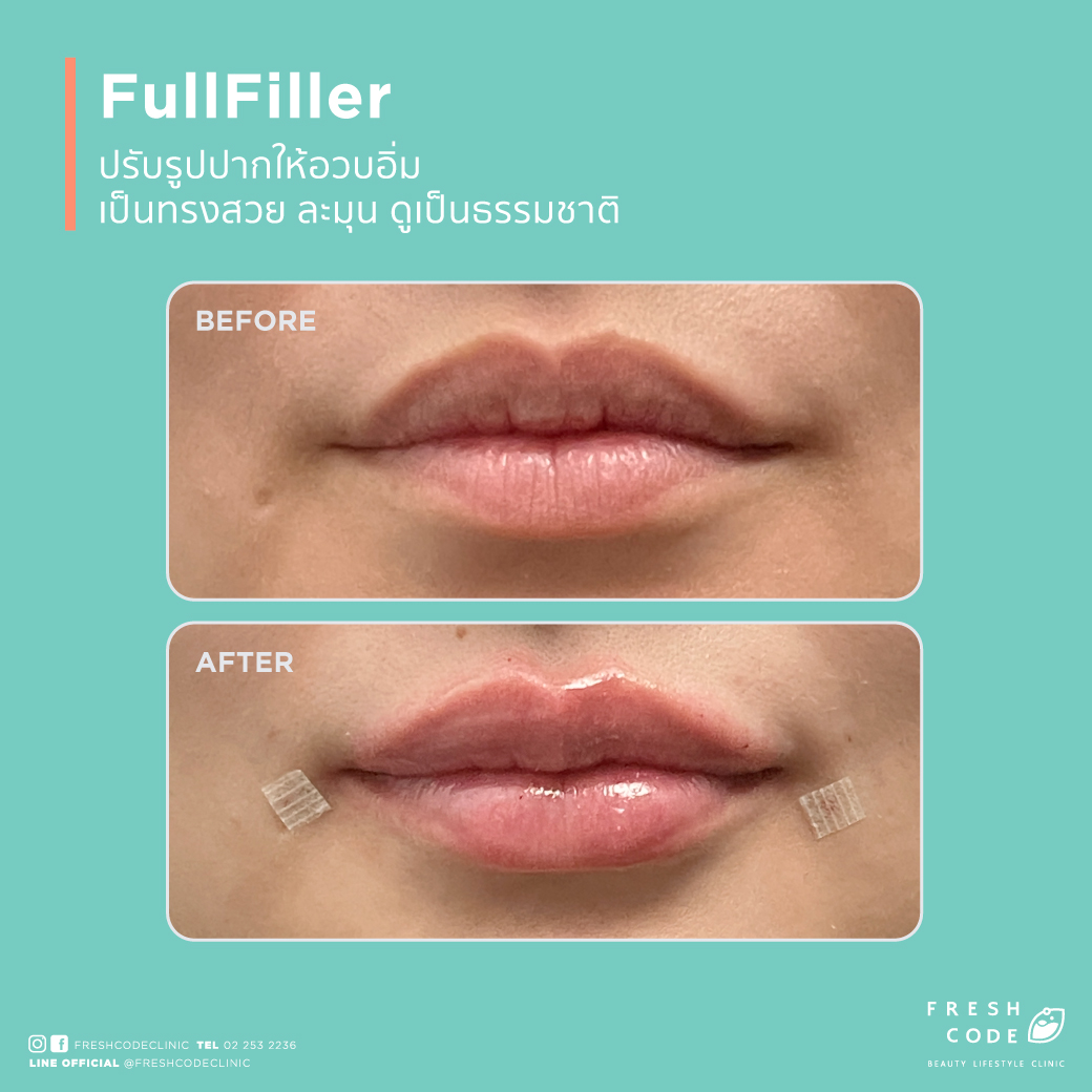 ฟิลเลอร์ปาก สไตล์ Fresh Code Clinic | เติมปากอวบอิ่มอย่างเป็นธรรมชาติ ที่ใครๆ ก็ทักว่าดูดี ...
