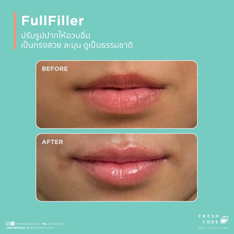 ฟิลเลอร์ปาก สไตล์ Fresh Code Clinic | เติมปากอวบอิ่มอย่างเป็นธรรมชาติ ที่ใครๆ ก็ทักว่าดูดี ...