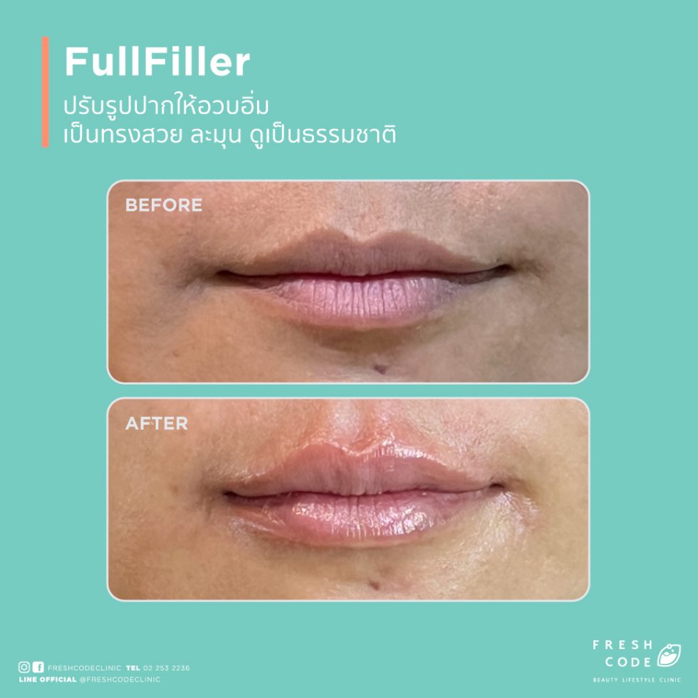 ฟิลเลอร์ปาก สไตล์ Fresh Code Clinic | เติมปากอวบอิ่มอย่างเป็นธรรมชาติ ที่ใครๆ ก็ทักว่าดูดี ...