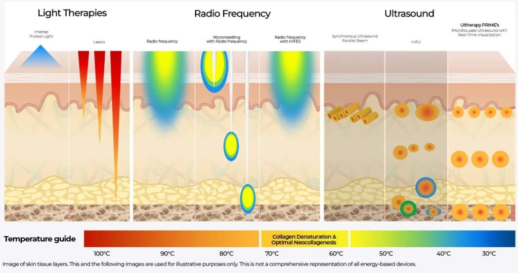 Ultherapy Prime | FreshCodeClinic